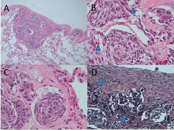 Unusual presentation of incidental atypical carcinoid tumor ...