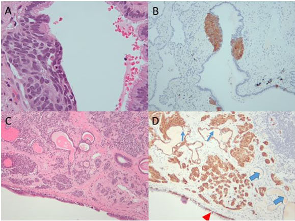 Unusual presentation of incidental atypical carcinoid tumor ...